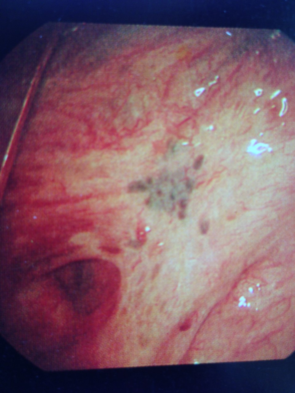 ENDOMETRIOSIS. Diagnostico, Estadiage y Tratamiento. – Dr. Francisco ...