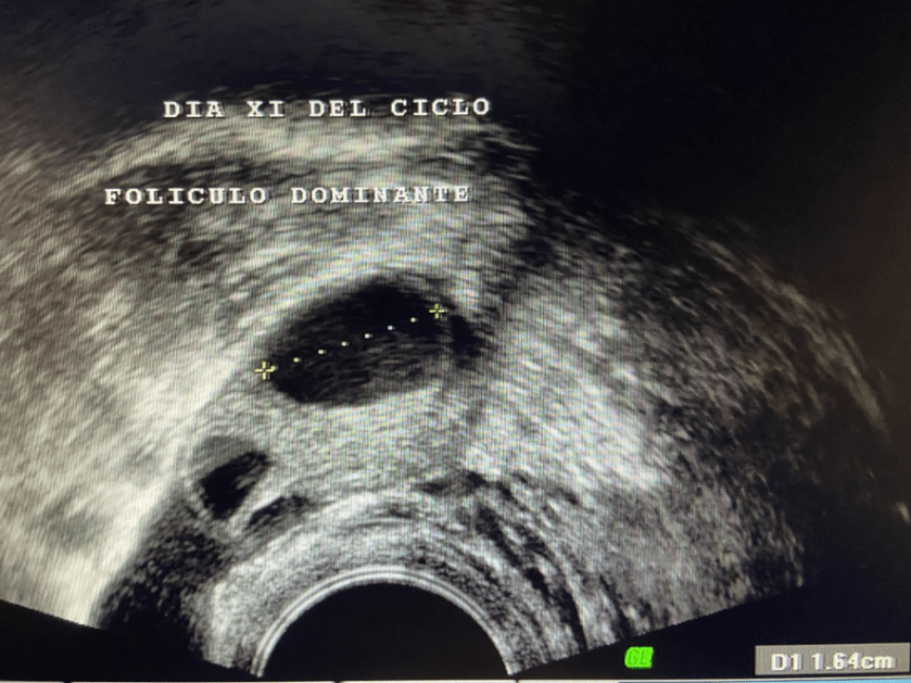 CICLO MENSTRUAL. Fase folicular-Proliferativa. (2ª parte). – Dr ...