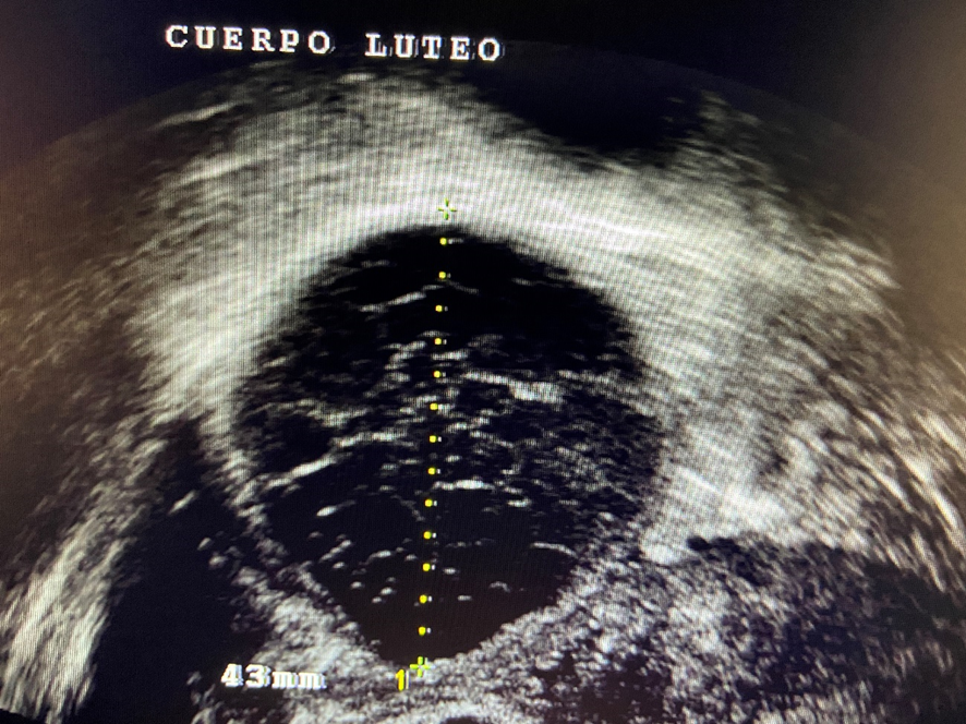 CICLO MENSTRUAL. Fase lútea o secretora. (1ª parte). – Dr. Francisco ...