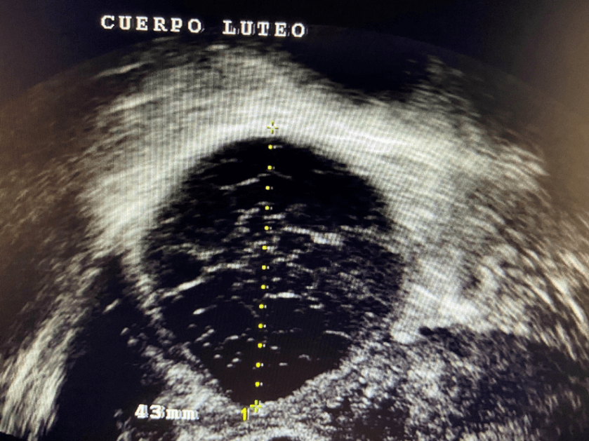 CICLO MENSTRUAL. Fase lútea o secretora. (1ª parte). – Dr. Francisco ...