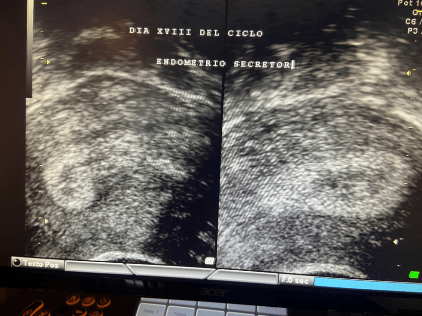 CICLO MENSTRUAL. Fase lútea o secretora. (1ª parte). – Dr. Francisco ...